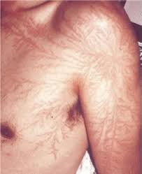 Lebanon News, Breaking News - [PHOTOS] Lightning Strike Scars Look ...